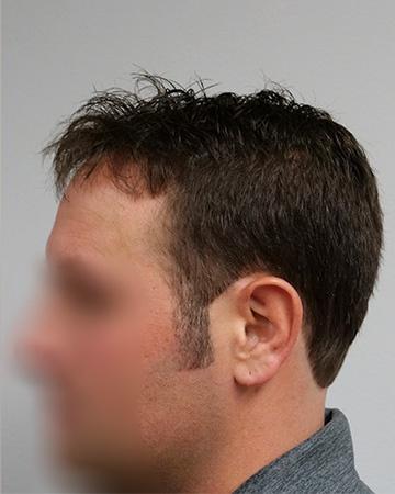 Men's Hair Restoration Systems | New Image Hair Clinic