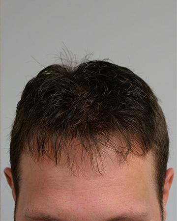 Men's Hair Restoration Systems | New Image Hair Clinic